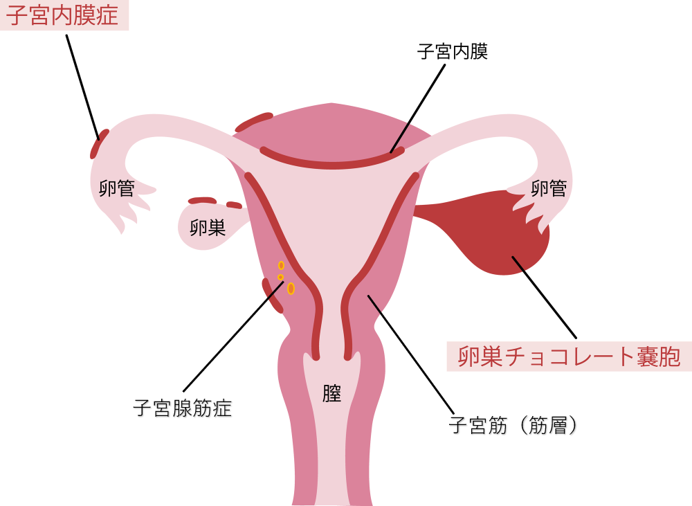 子宮腺筋症の原因はストレス？症状チェックや治療方法｜京都の足立病院 